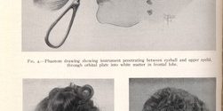 An Early Advertisement for Lobotomy — MFIPortal